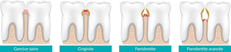 Parodontite : qu’est-ce que c’est et comment la soigner