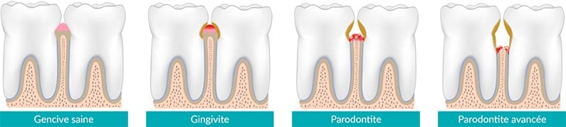 Parodontite : qu’est-ce que c’est et comment la soigner