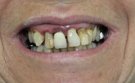 Parodontite : qu’est-ce que c’est et comment la soigner