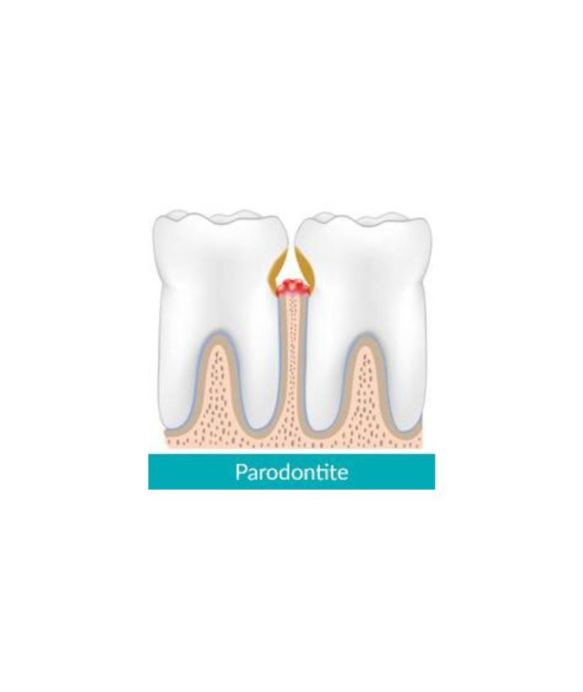 Parodontite : qu’est-ce que c’est et comment la soigner