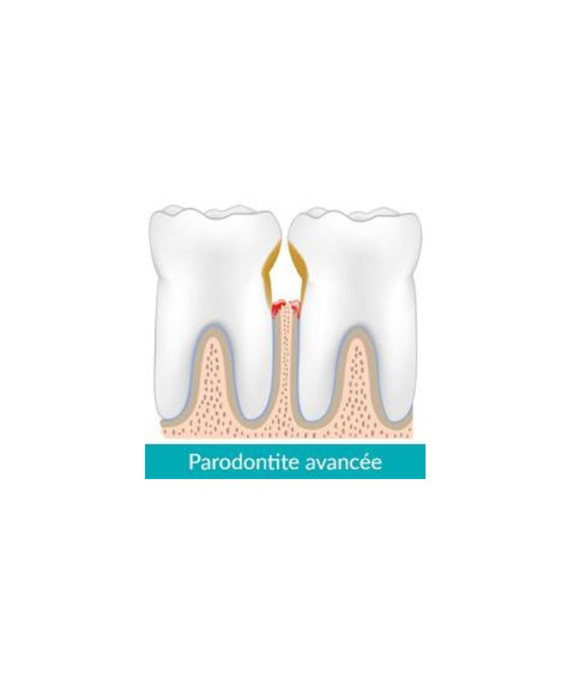 Parodontite : qu’est-ce que c’est et comment la soigner