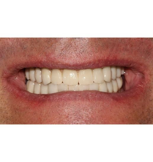 ᐅ Prothèse Dentaire Transvissée Refaire ses Dents au Meilleur Prix