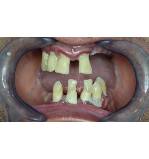 ᐅ Prothèse Dentaire Transvissée Refaire ses Dents au Meilleur Prix